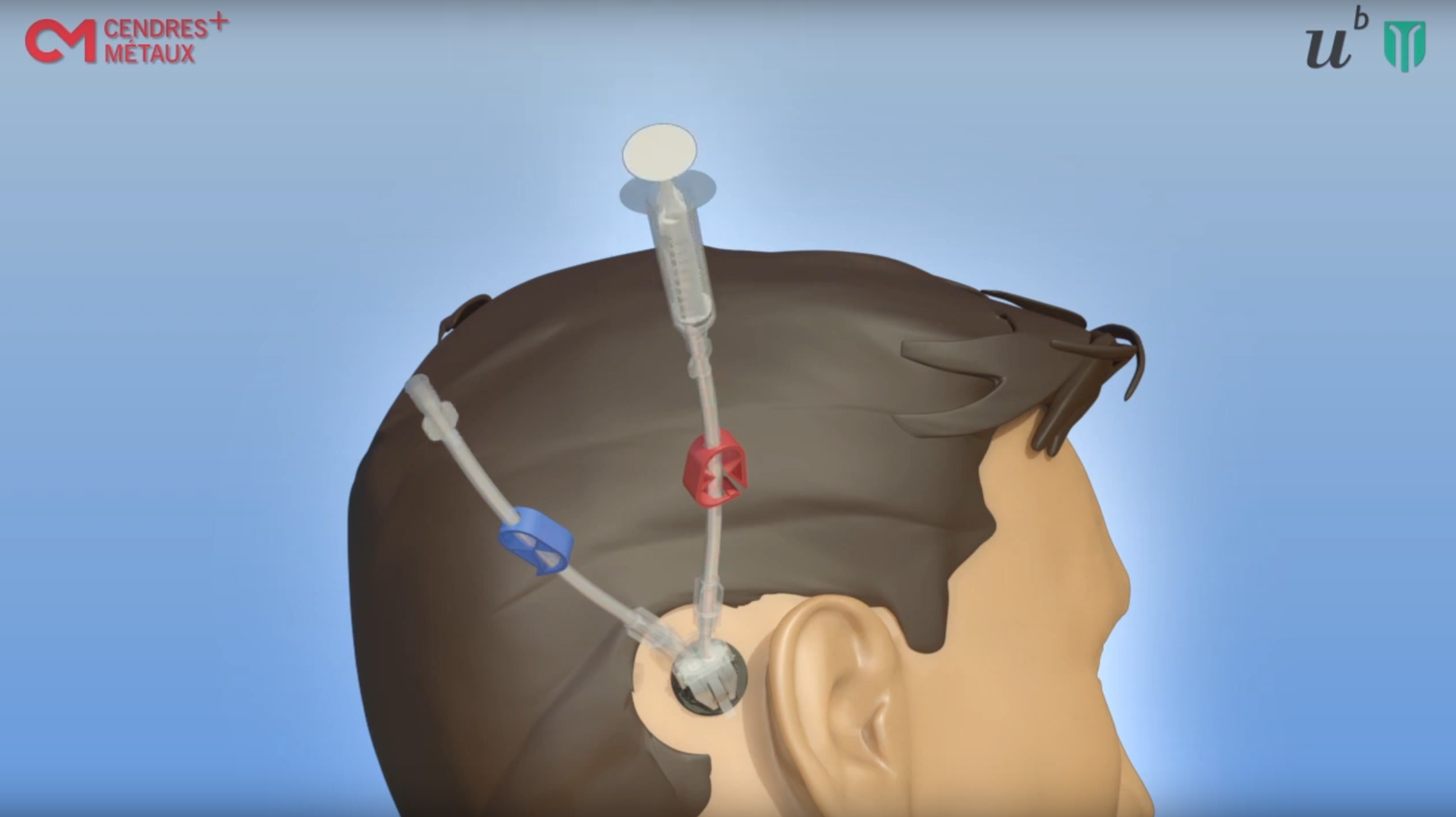 Dialyse Port | Medizinische Visualisierung - Viscope-3D